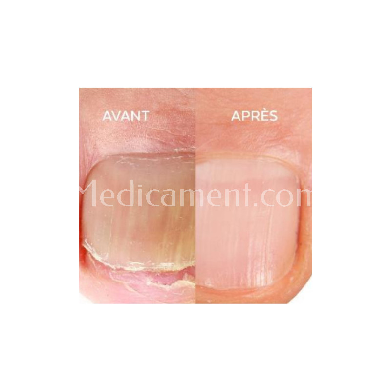 Ongles incarnés Sérum Apaisant PODERM